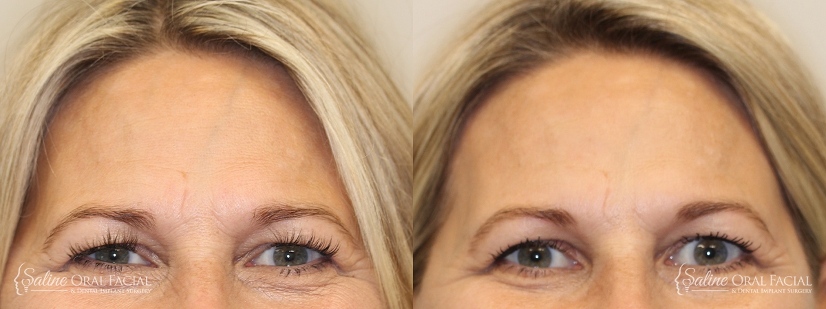 BOTOX® Saline, MI | Saline OMS