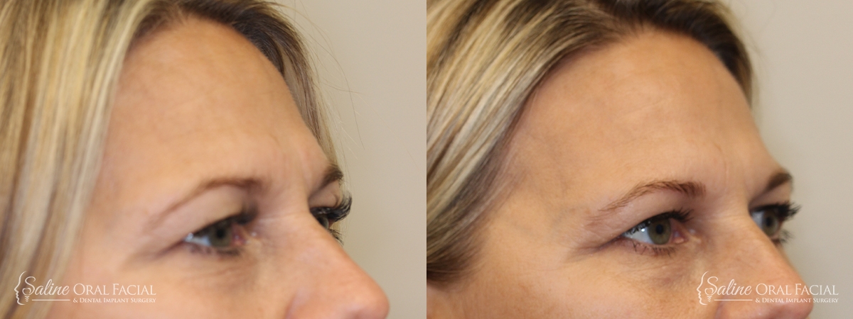 BOTOX® Saline, MI | Saline OMS